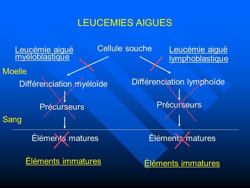 La Leucémie aiguë myéloblastique - LEUCEMIE 06